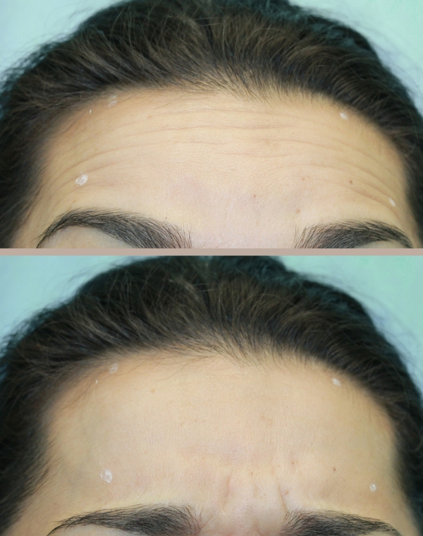 Botulotoxin – CBP Klinika